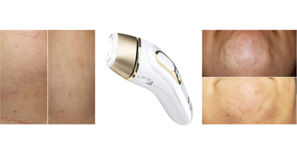 13 Best At Home Laser Hair Removal Machines 2022 | Woman's World