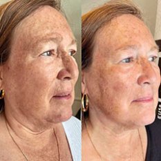 60-Year-Old's Surgery-Free Turkey Neck Solution | Woman's World