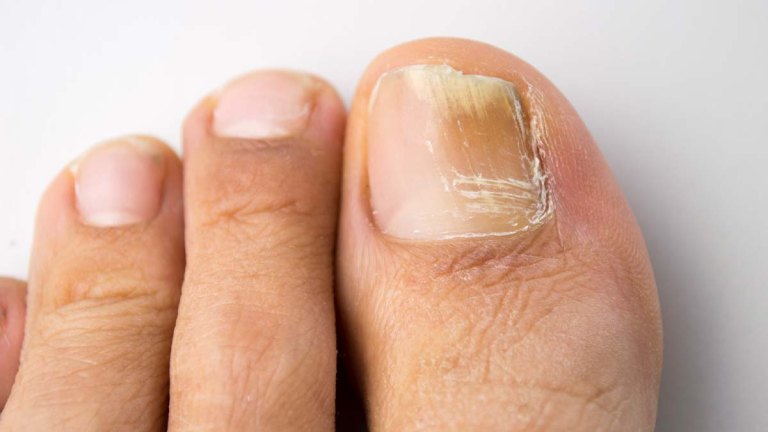 Finding This On Your Nails May Be A Sign Of Diabetes Woman S World