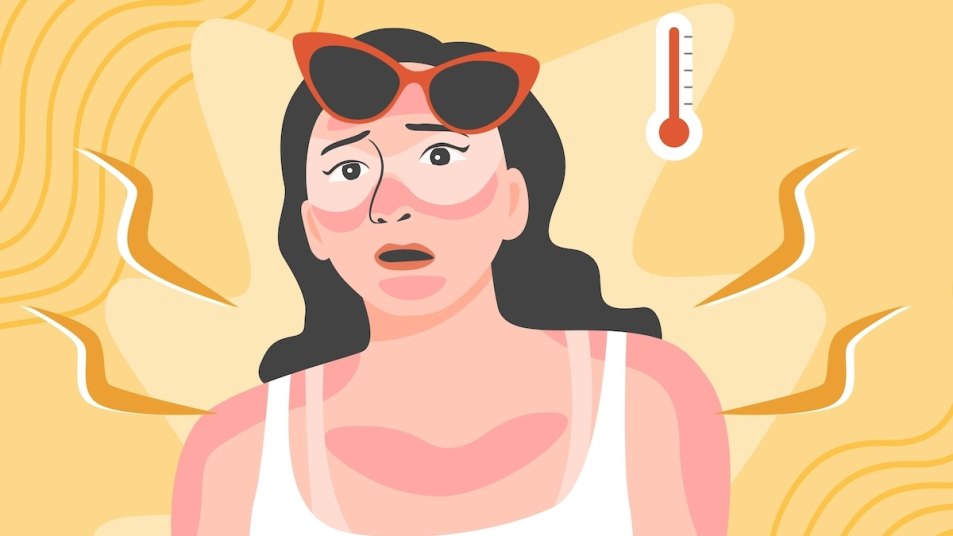 How To Relieve and Get Rid of a Sunburn Fast | Woman's World