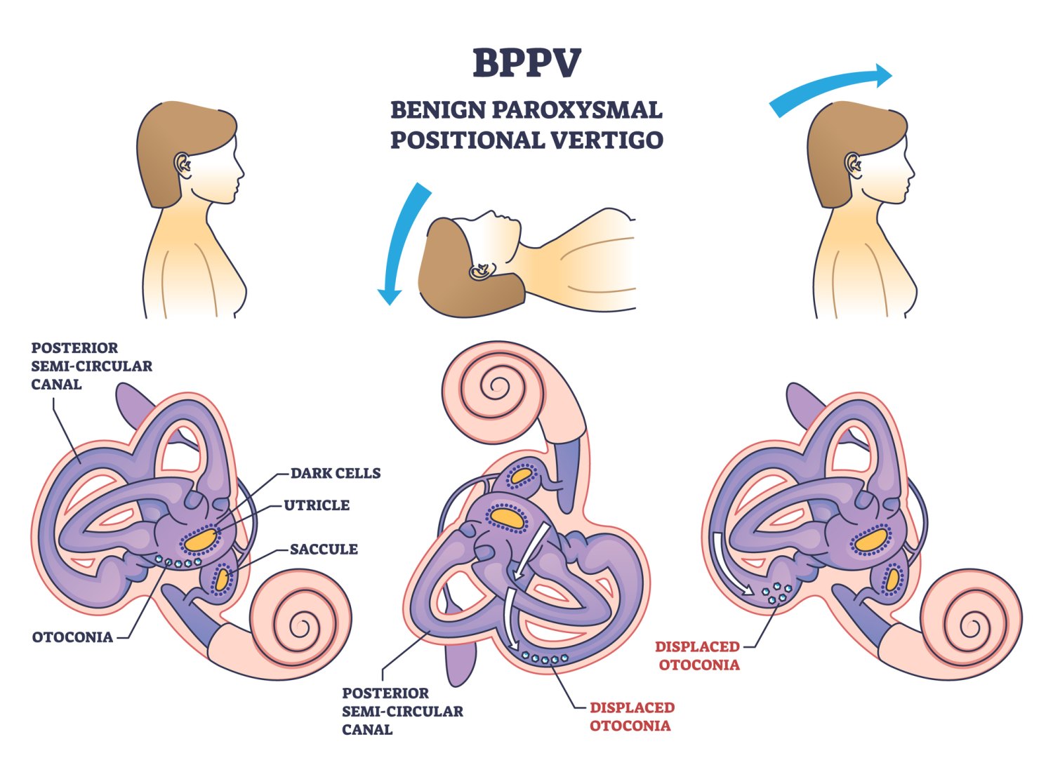 How To Tell Which Ear Is Causing Vertigo, Plus the Epley Maneuver Fix ...