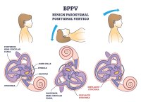 How To Tell Which Ear Is Causing Vertigo, Plus the Epley Maneuver Fix ...
