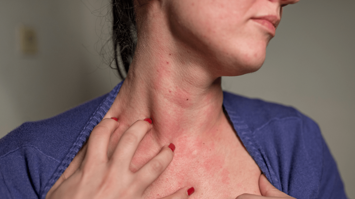 Poor Thyroid Health And Skin Rash Signs And Symptoms Woman s World Poor Thyroid Health And Skin Rash Signs And Symptoms Woman s World