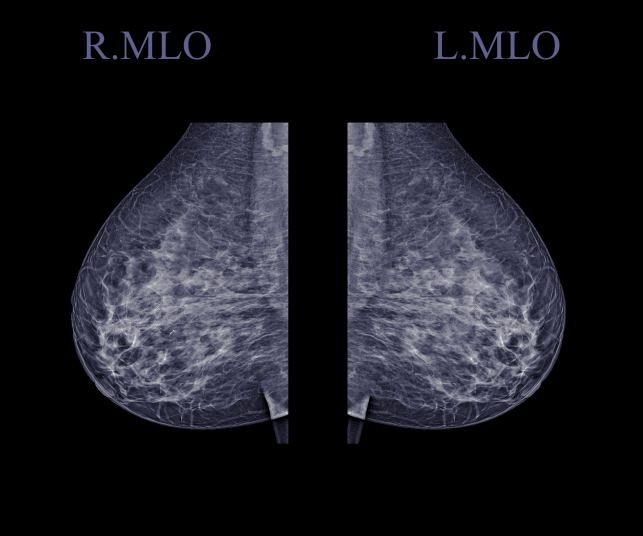 Dense Breast Tissue and Cancer Risk: What the New FDA Rule Means ...
