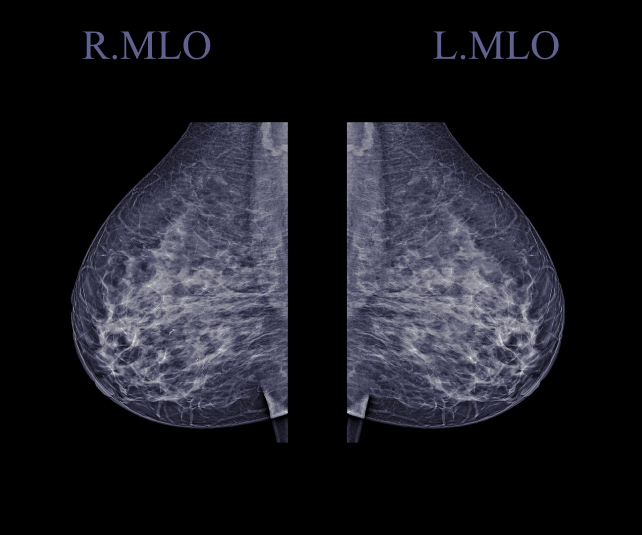 Dense Breast Tissue and Cancer Risk: What the New FDA Rule Means ...