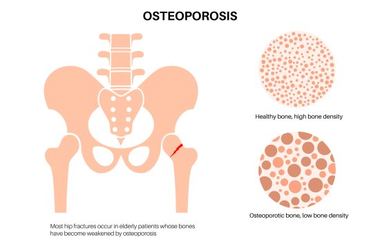 How To Build Bone Density Naturally and Prevent Osteoporosis | Woman's ...