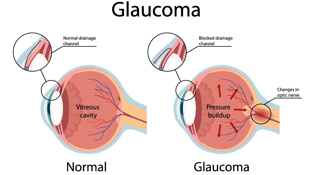 Glaucoma vs Cataracts: What Eye Doctors Want You to Know | Woman's World