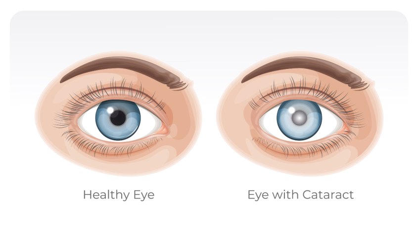 Glaucoma vs Cataracts: What Eye Doctors Want You to Know | Woman's World