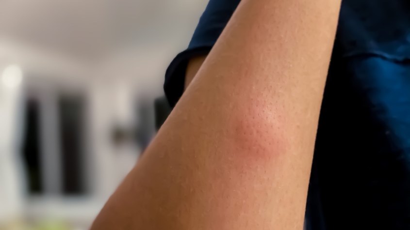 Is Your Infected Mosquito Bite Cellulitis? How To Tell + Treat It ...