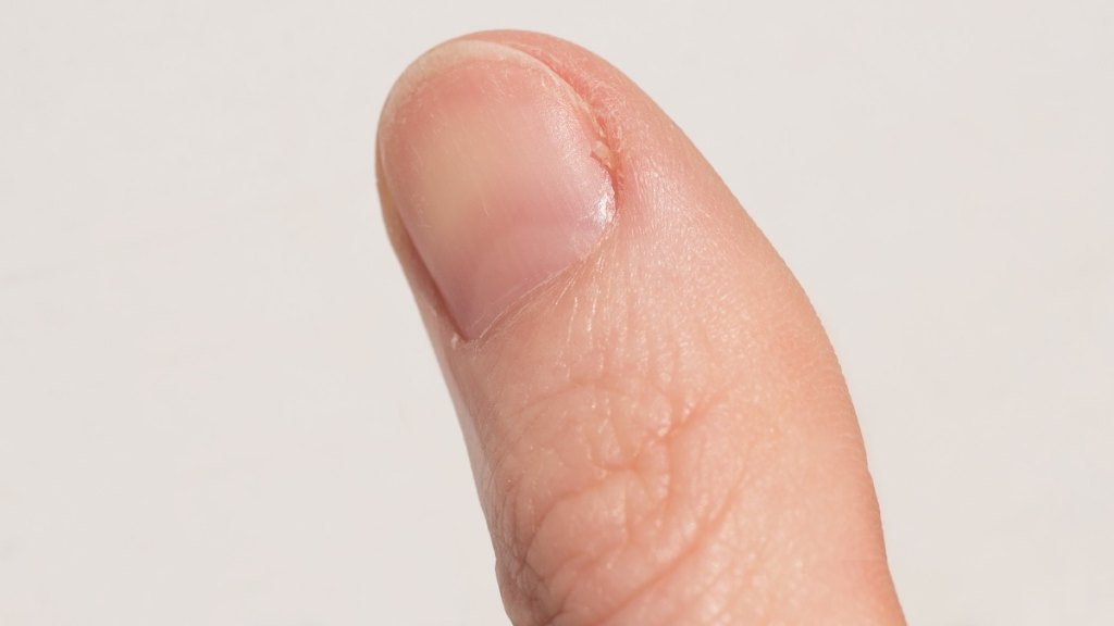 Infected Hangnail? Doctors Say These 4 Tips Speed Healing | Woman's World