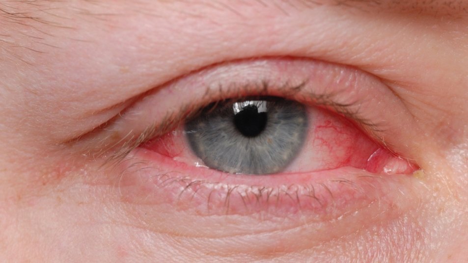 Conjunctivitis Self-Care: Eye Docs’ Top Tips To Soothe Pink Eye | Woman ...