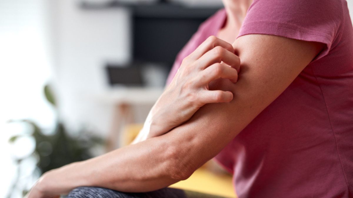 Is Your Infected Mosquito Bite Cellulitis? How To Tell + Treat It ...