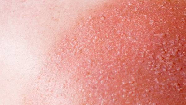 How To Get Rid of a Heat Rash Quickly With 6 Home Remedies | Woman's World