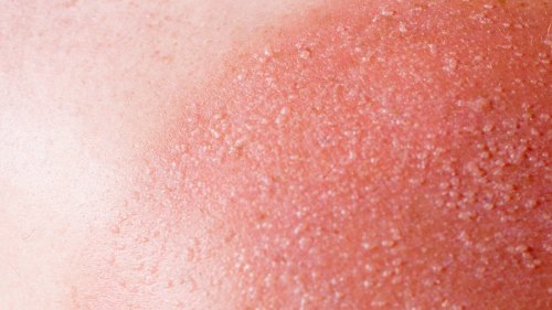 How To Get Rid of a Heat Rash Quickly With 6 Home Remedies | Woman's World
